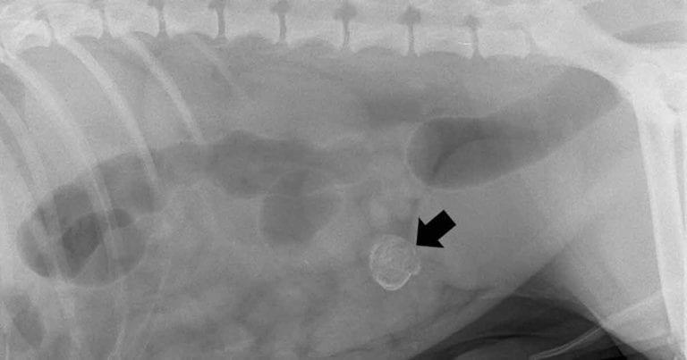 Omphalomesenteric Cyst